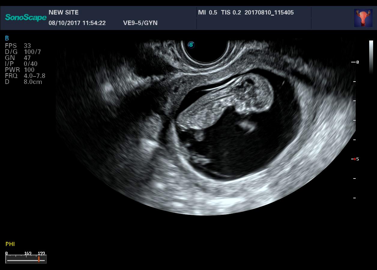 Ultrazvuk SonoScape P50 | Medical Centar