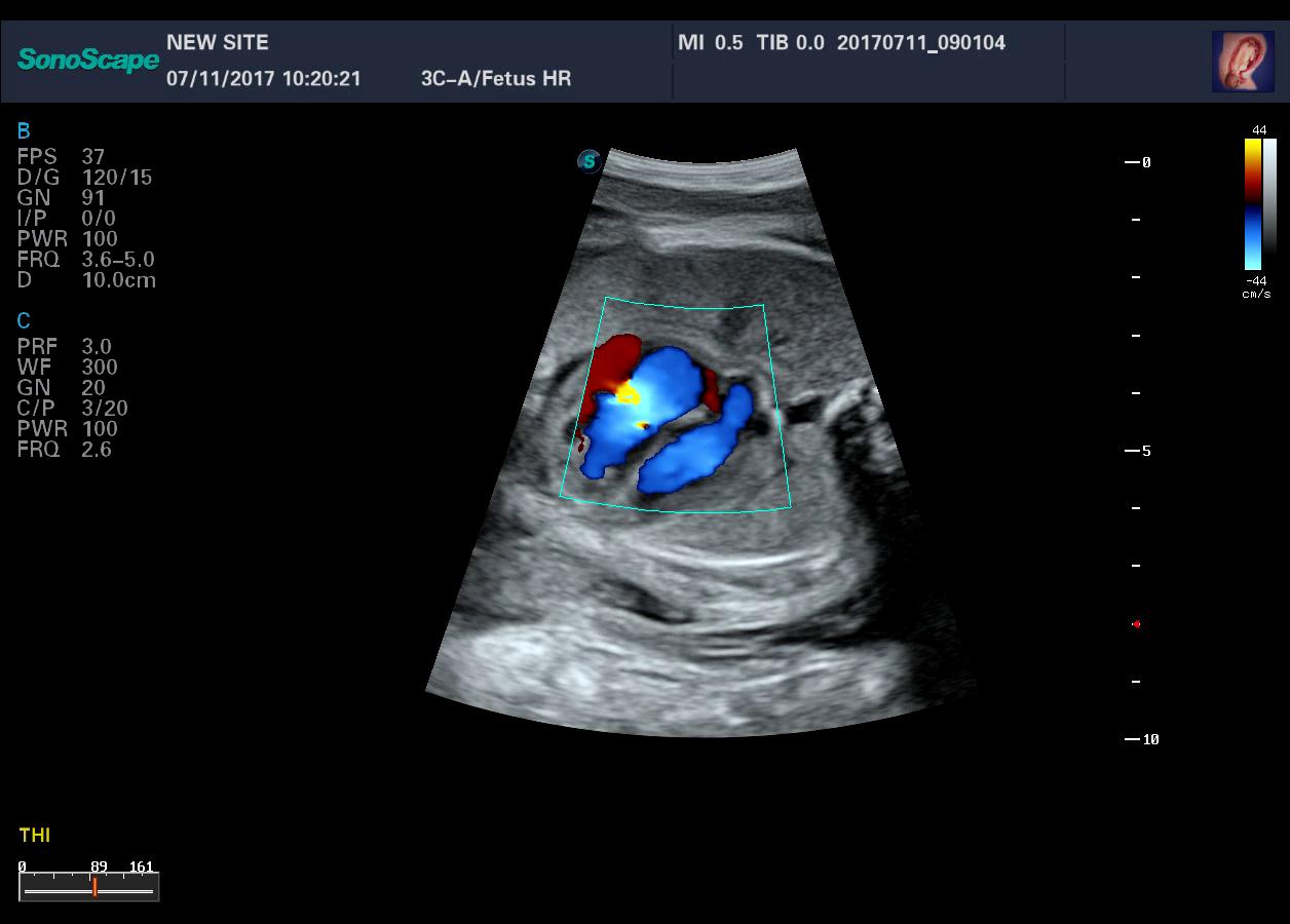 Ultrazvuk SonoScape P50 | Medical Centar