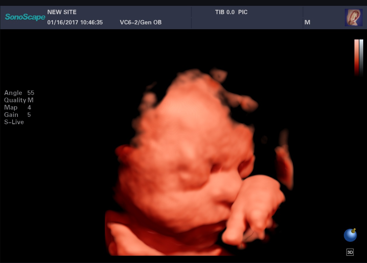 Ultrazvuk SonoScape P50 | Medical Centar