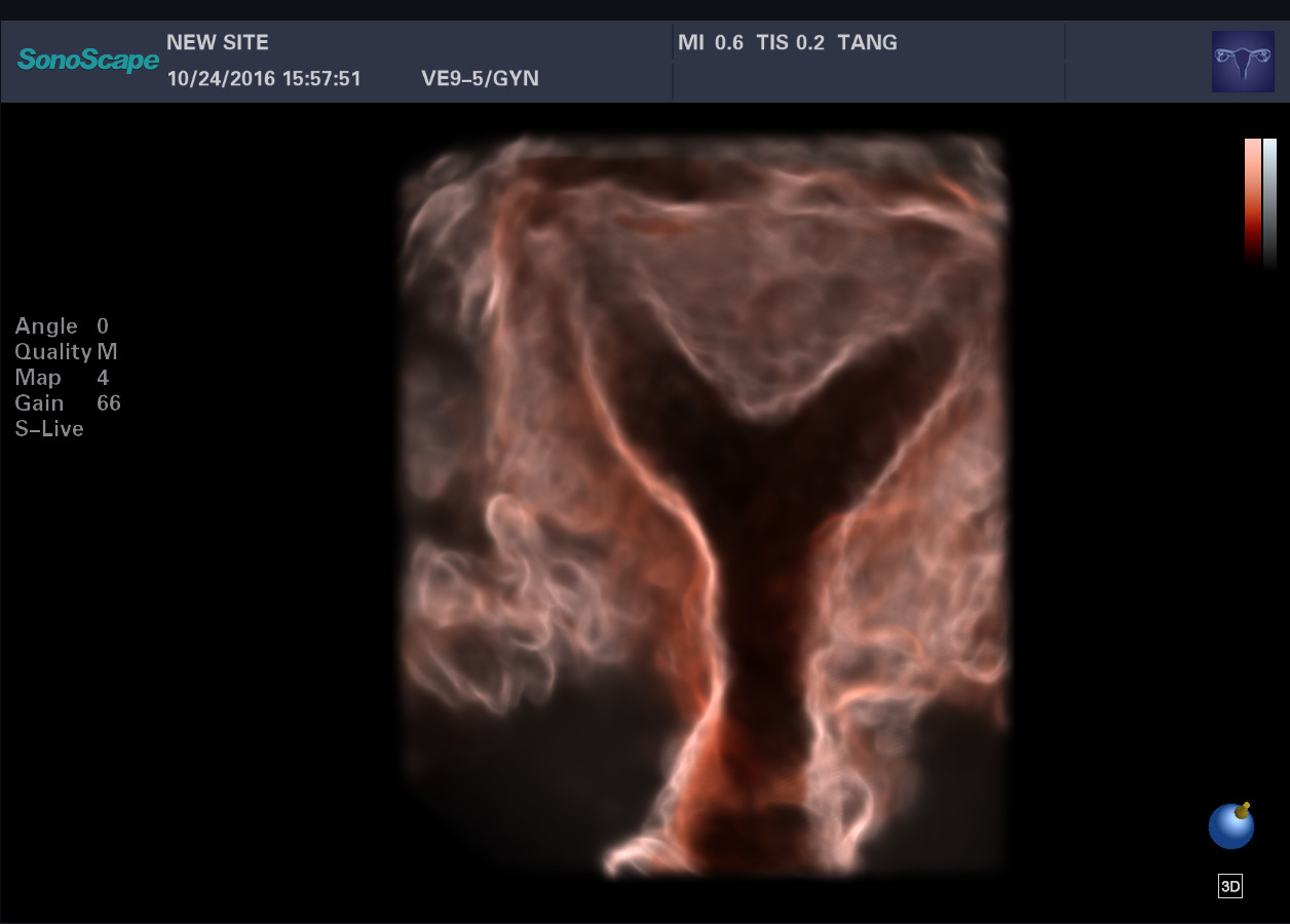 Ultrazvuk SonoScape P50 | Medical Centar
