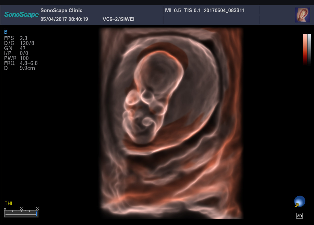 Ultrazvuk SonoScape P50 | Medical Centar