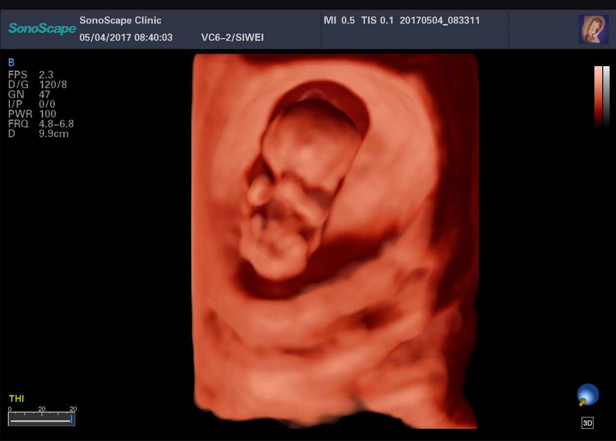 Ultrazvuk SonoScape P50 | Medical Centar