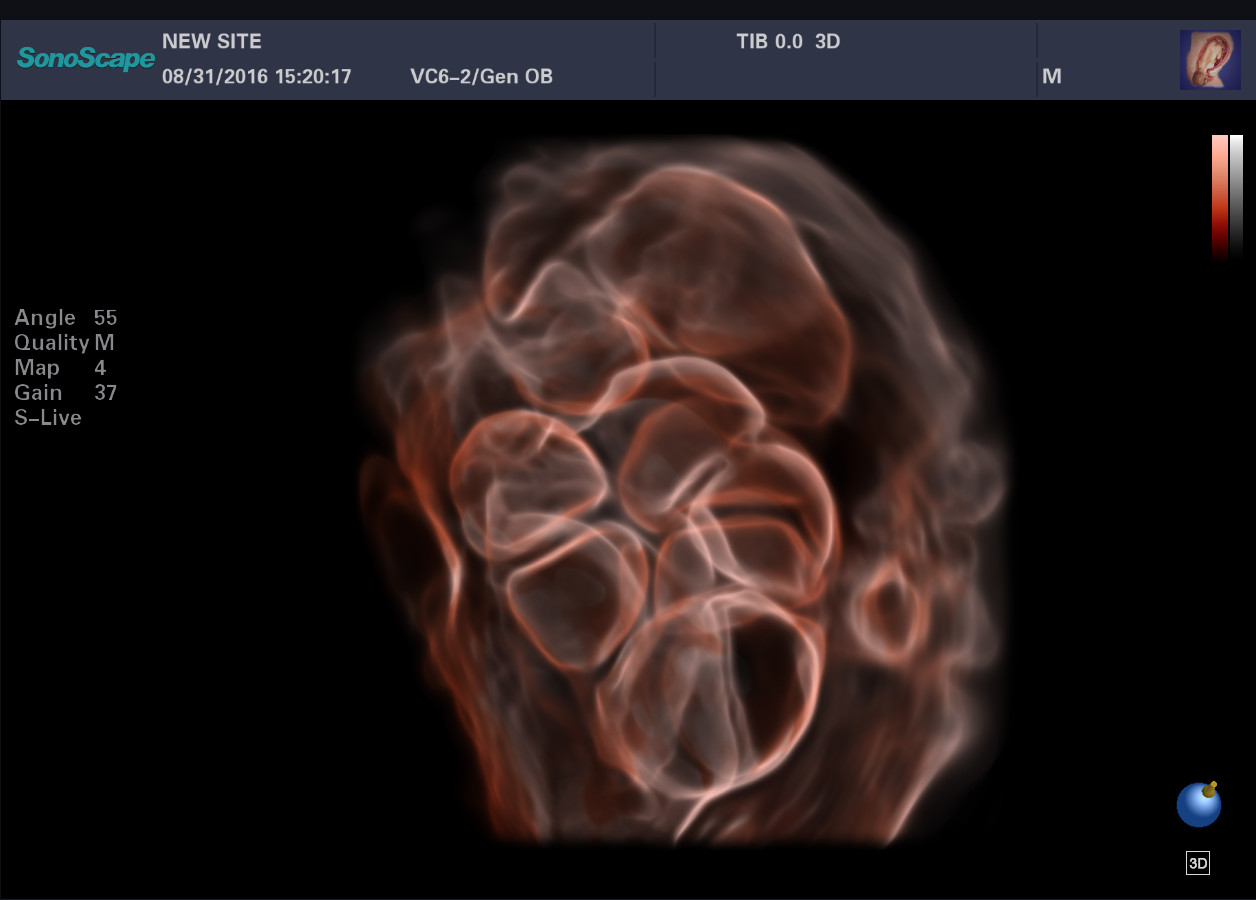 Ultrazvuk SonoScape P50 | Medical Centar
